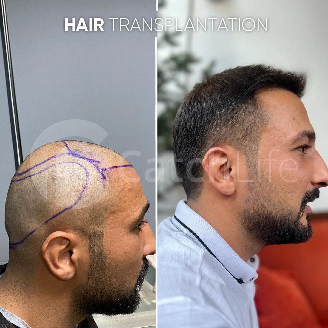 Hair Transplant Turkey – Hair Transplant Packages Price – CatchLife ...